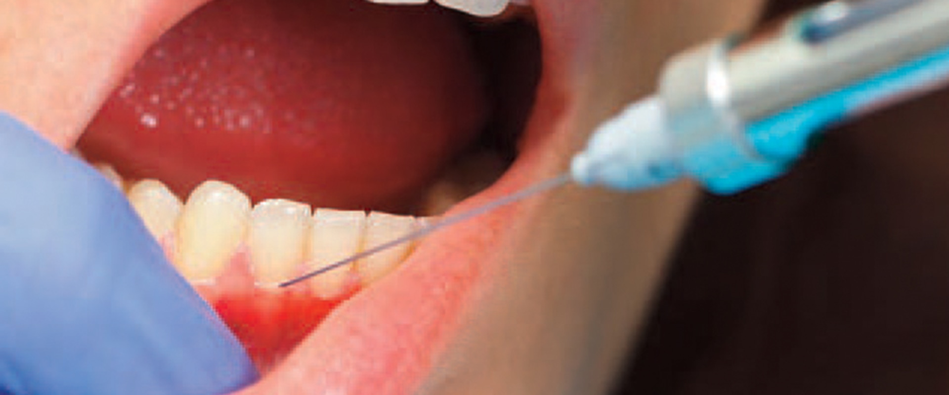 How Long Does a TENS Treatment Last in Dentistry?