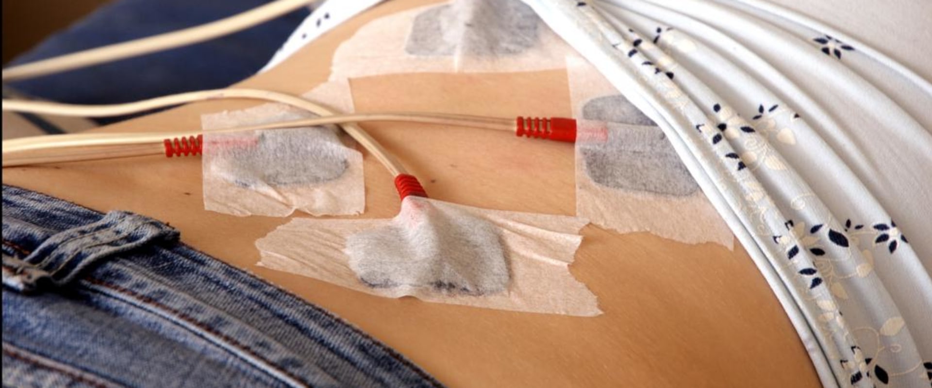 Understanding the Benefits of Transcutaneous Electrical Nerve ...